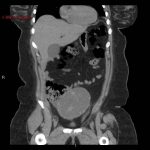 Abdominal CT Scan | Bluegrass Regional Imaging